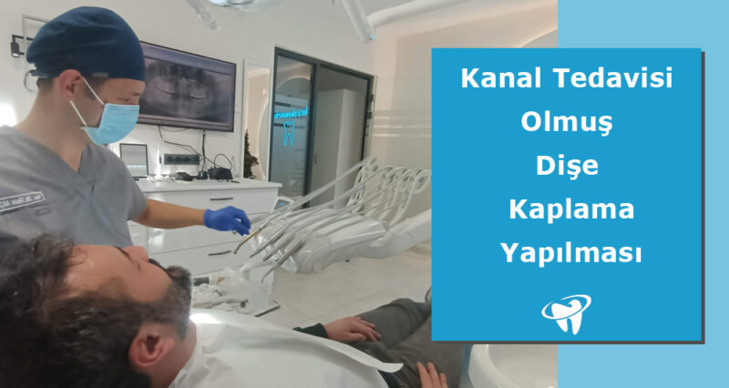 Kanal Tedavisi Olmuş Dişe Sonradan Kaplama Yapılması